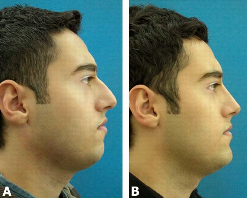 ¿QUÉ ES LA MENTOPLASTIA? | INFO CIRUGÍA ESTÉTICA