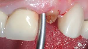 The Seibert`s classification of edentulous ridge regarding the apico ...