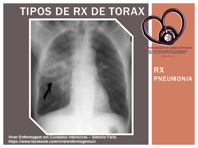 Viver Enfermagem em Cuidados Intensivos: RX TORAX NORMAL E PNEUMONIA ...