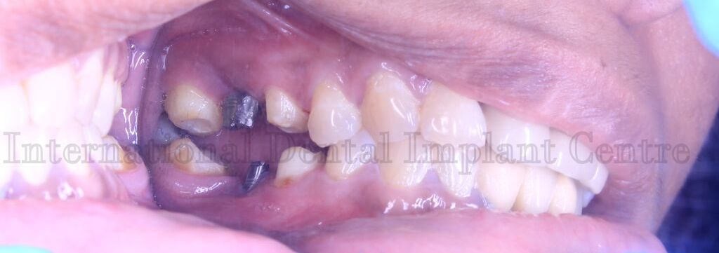 DR Murugavel's dental implant course: Upper and lower missing molar ...