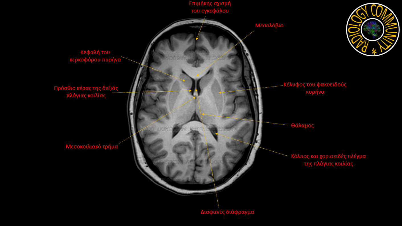 Radiology Community: Ανατομία Μαγνητικής Τομογραφίας Εγκεφάλου