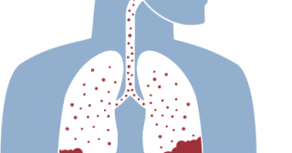 Mengenal Penyakit Asbestosis