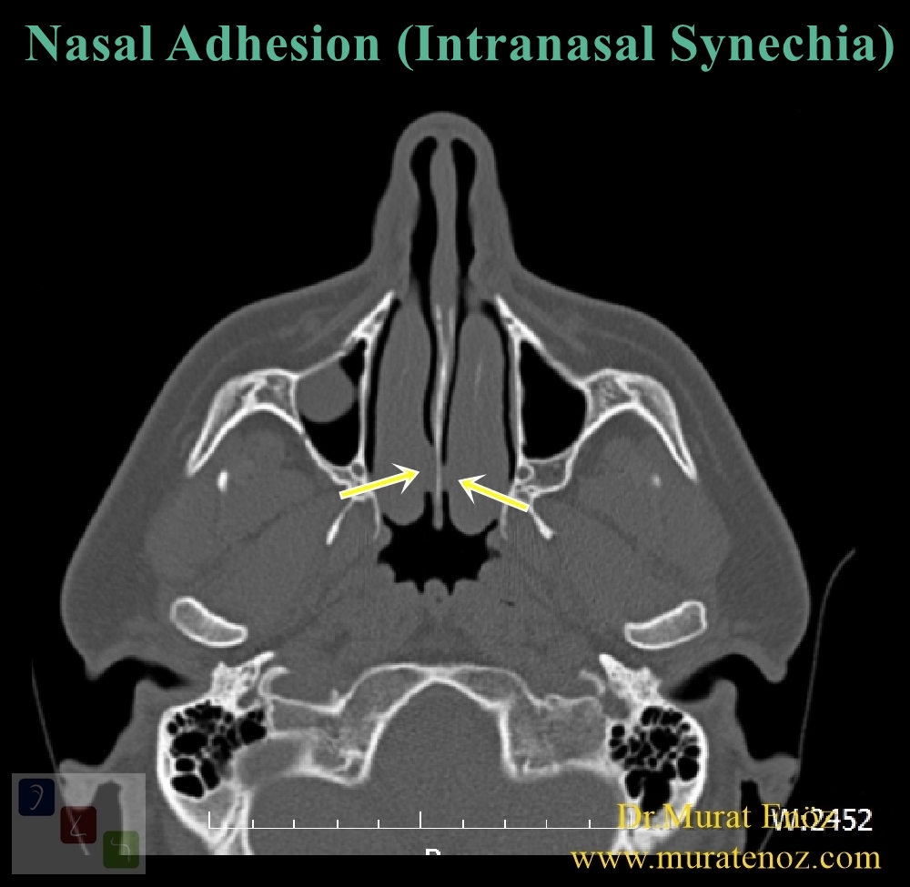 Nasal Cavity Adhesion (Synechia) - Definition, Causes, Symptoms and ...