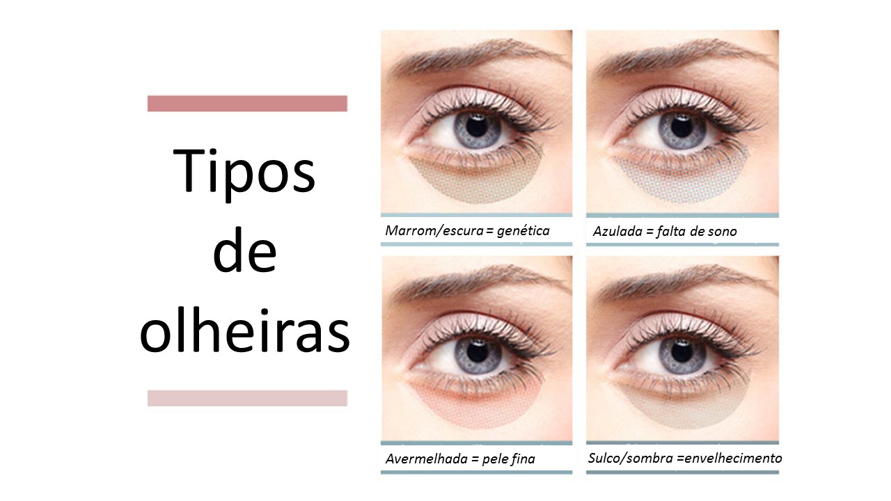 Pele em Foco: Olheiras: quando tratar com preenchimento?