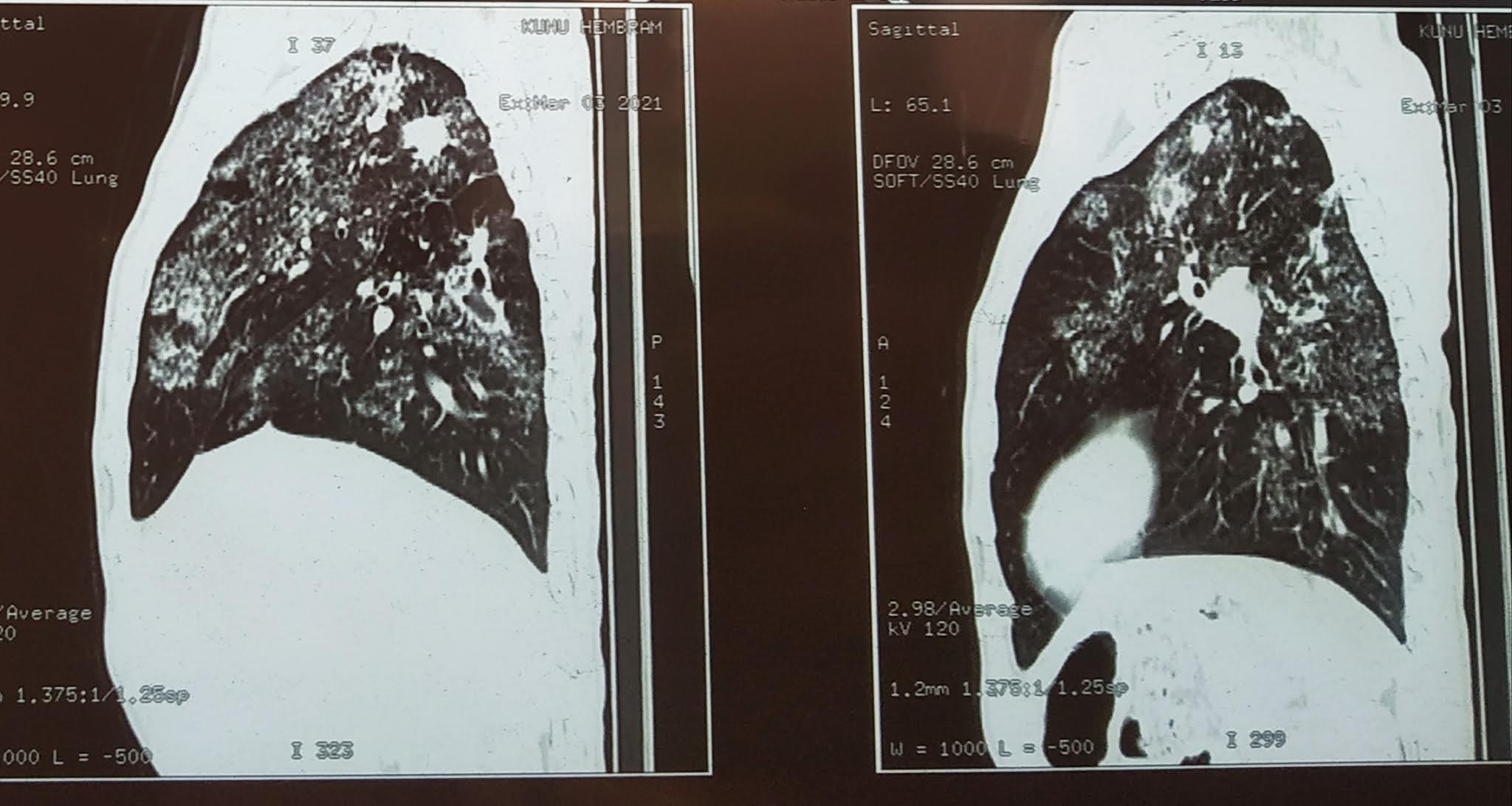 'Tree in Bud' sign (Extensive Lesions) 🌲🌲