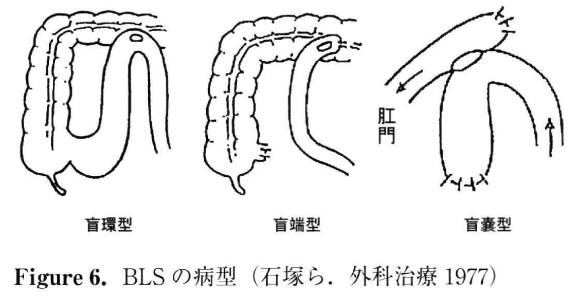 松下 ER ランチ・カンファレンス: ブラインドループ症候群 Blind loop syndrome