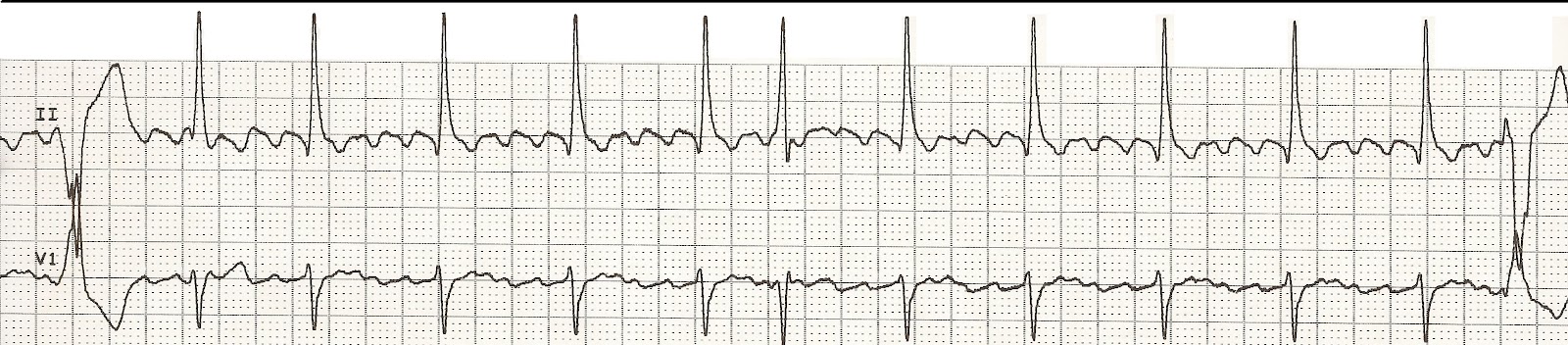 EKG Rhythm Strip Quiz 17