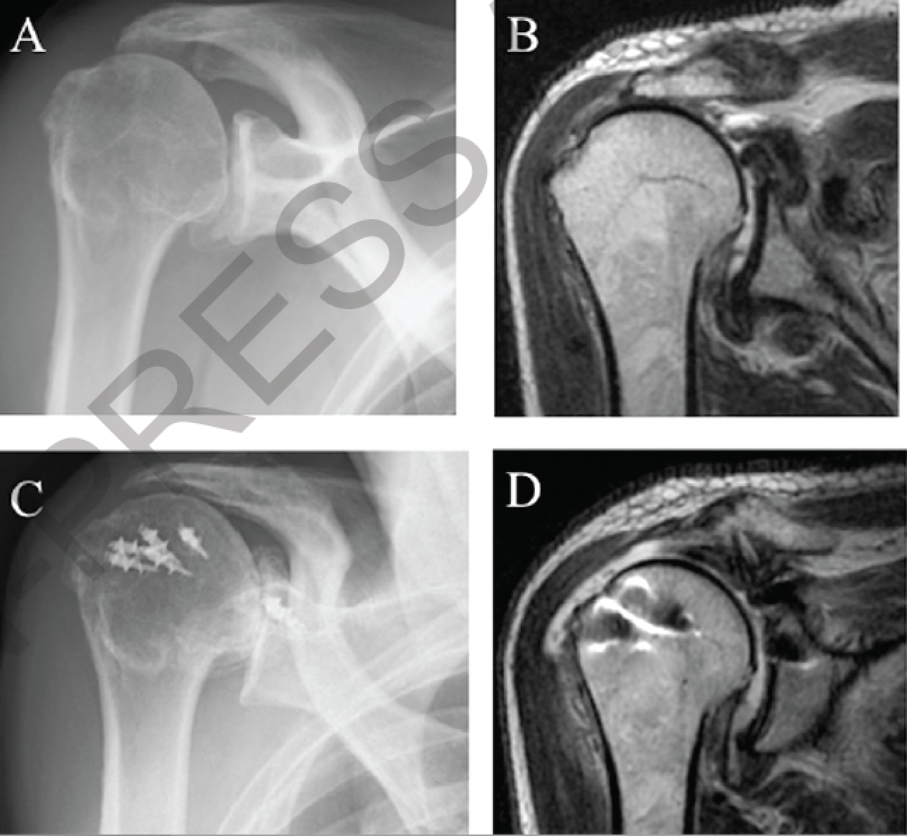 Shoulder Arthritis/Joint Replacement Rotator cuff tears: Superior ...