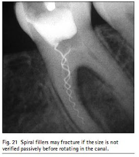 Endodontic: Spiral root canal fillers