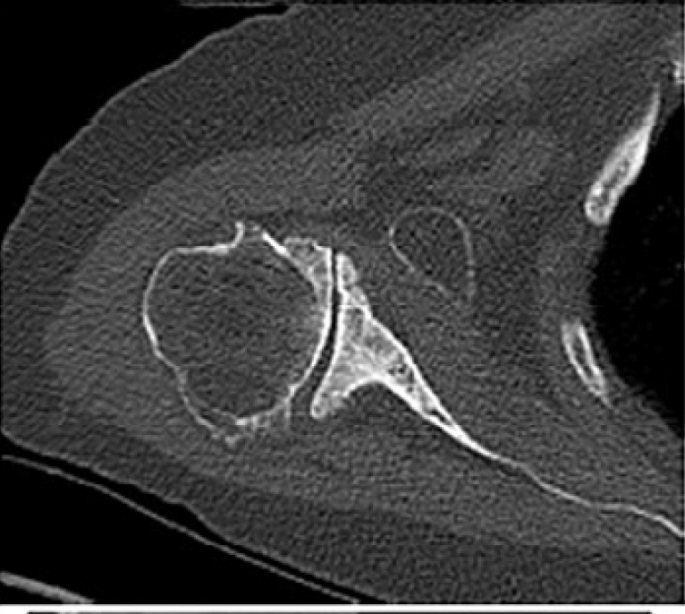 UW Shoulder and Elbow Academy: Glenoid components with trabecular metal ...