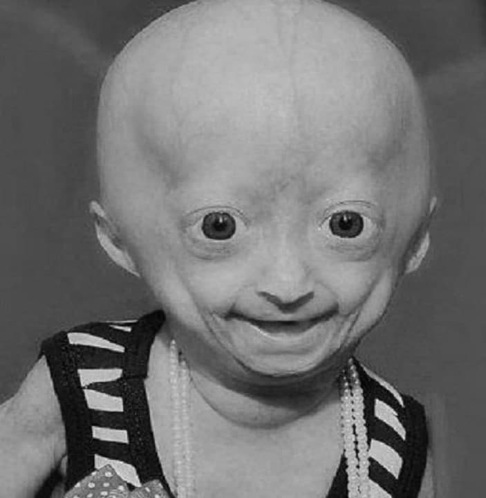 Medical Terms & Сlinical Сases : Hallermann-Streiff-François syndrome