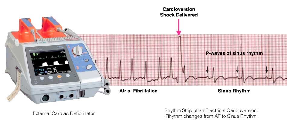 Técnicas y procedimientos de Enfermería: CARDIOVERSIÓN