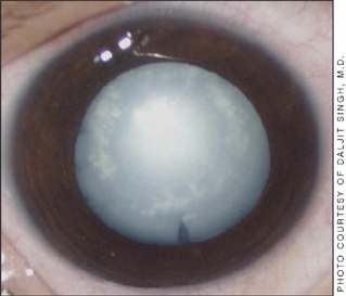 Kaca Mata Dunia: Katarak