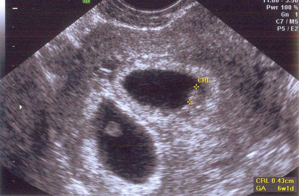 Taj Ma Baby: 6 Week Scan