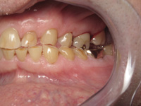 Signs and Symptoms of Occlusal Disease