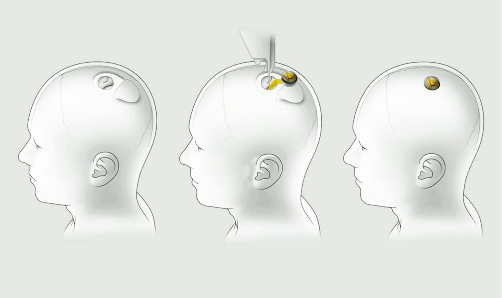 What is Brain Chip? | Neuralink Brain Chip Implant | Neuralink Elon ...