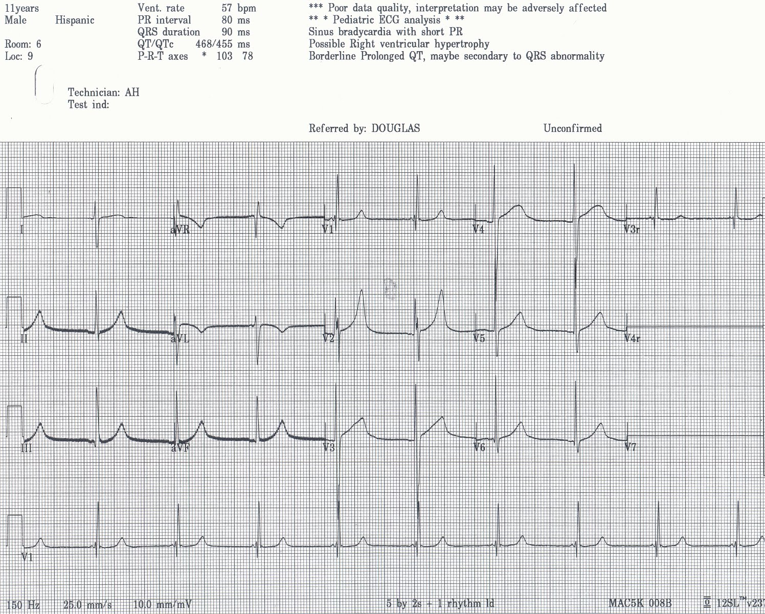 Pedi cardiology: Quiz, EKG: What is the rhythm? Junctional vs. Low ...