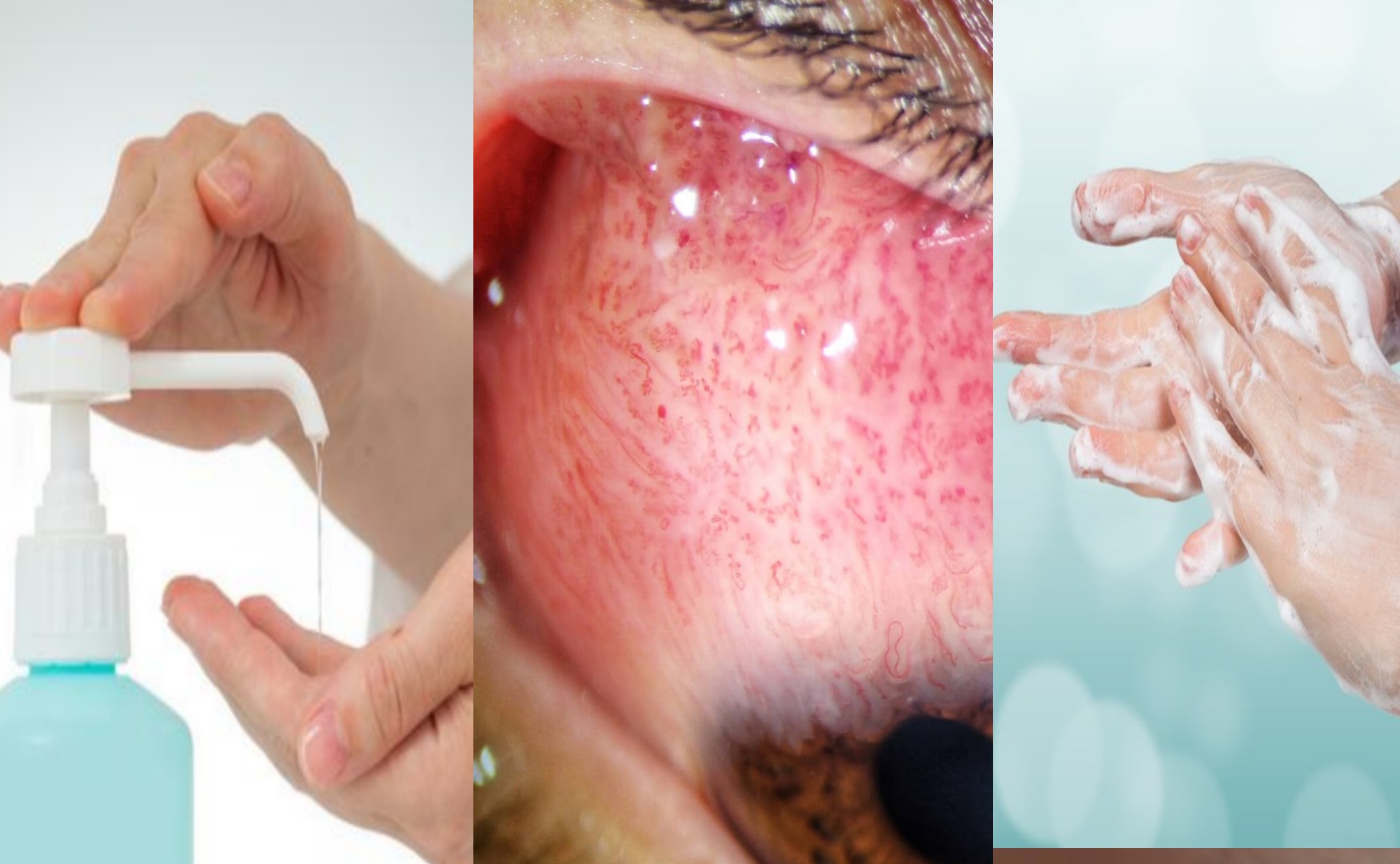 Vous souffrez de la conjonctivite?! appliquez l'un de ces 4 traitements ...