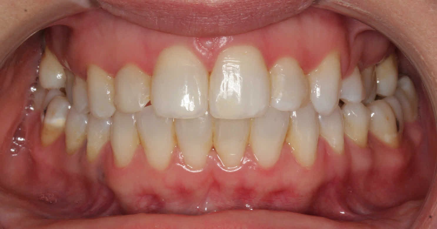 Shifted teeth - scanres