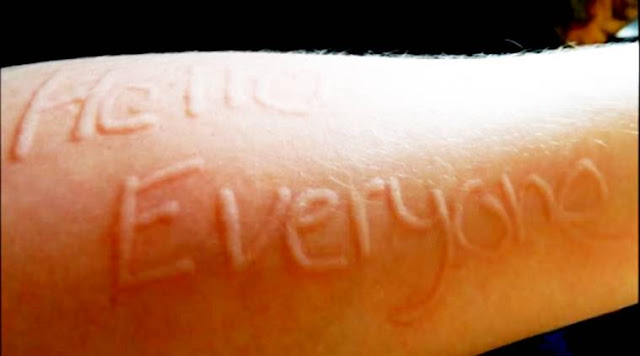The Kasihs: SKIN WRITING OR DERMATOGRAPHIA.