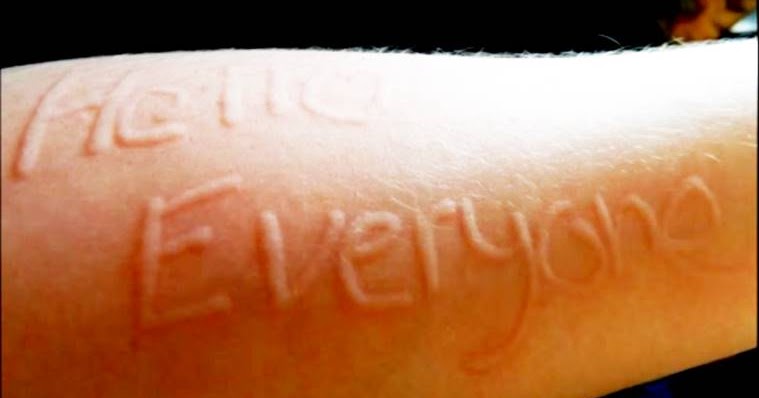 The Kasihs: SKIN WRITING OR DERMATOGRAPHIA.