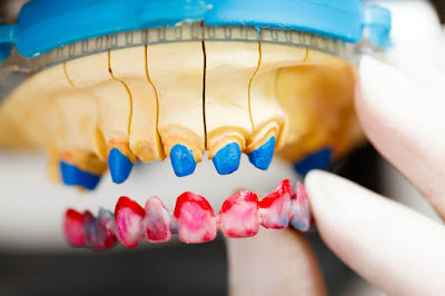 Regular PFM (Porcelain Fused To Metal) Crown And Bridge ~ Dr. Bharat ...