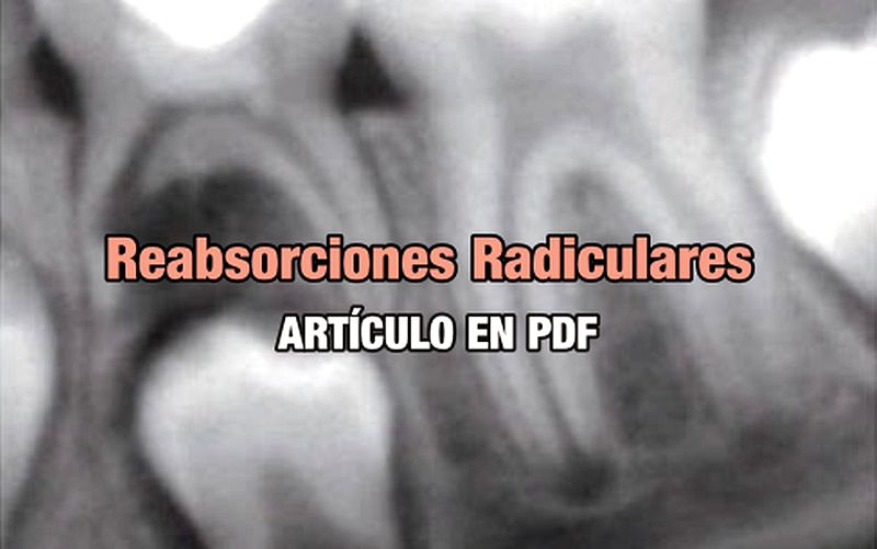 PDF: Reabsorciones radiculares: tipos, causas y manejo