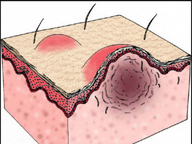 Reducing Unsightly Keloid Scars - how do?