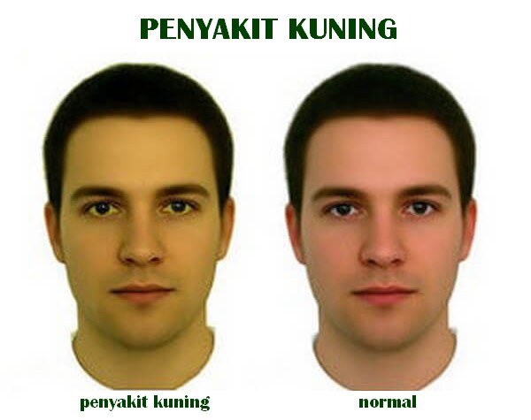 Tanda-tanda dan Gejala Serangan Jenis Penyakit Kuning dan Macam-macam ...