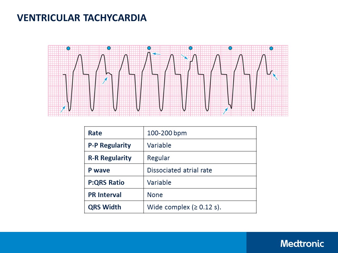 CVT Mohd Farid: Heart Rhythm Interpretation Part I-Medtronic Academy