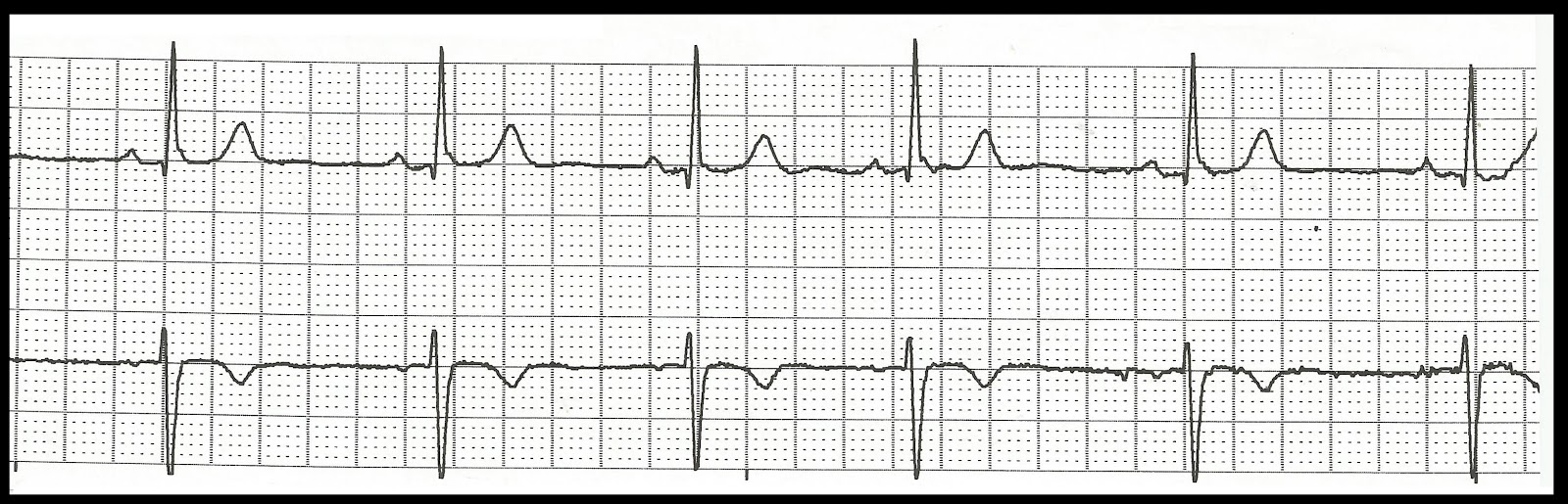 Characteristics of Sinus Rhythms