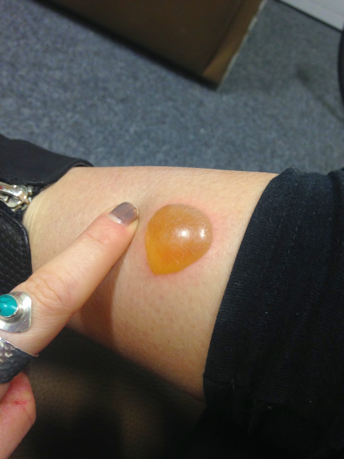 Carelle Says Hi...: My Spider Bite - Part 1