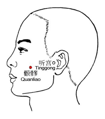 Acupuncture: SI - 18 (SMALL INTESTINE - 18)