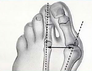 Bunion – What Exactly Are Bunions? - Bunion : What You Need To Know ...