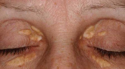Doctors Gates: Images for Skin manifestations in hyperlipidemia