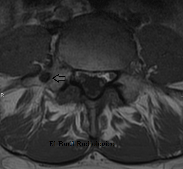 El Baúl Radiológico: ENOSTOSIS: ISLOTE ÓSEO (Bone Island: CT and MRI ...