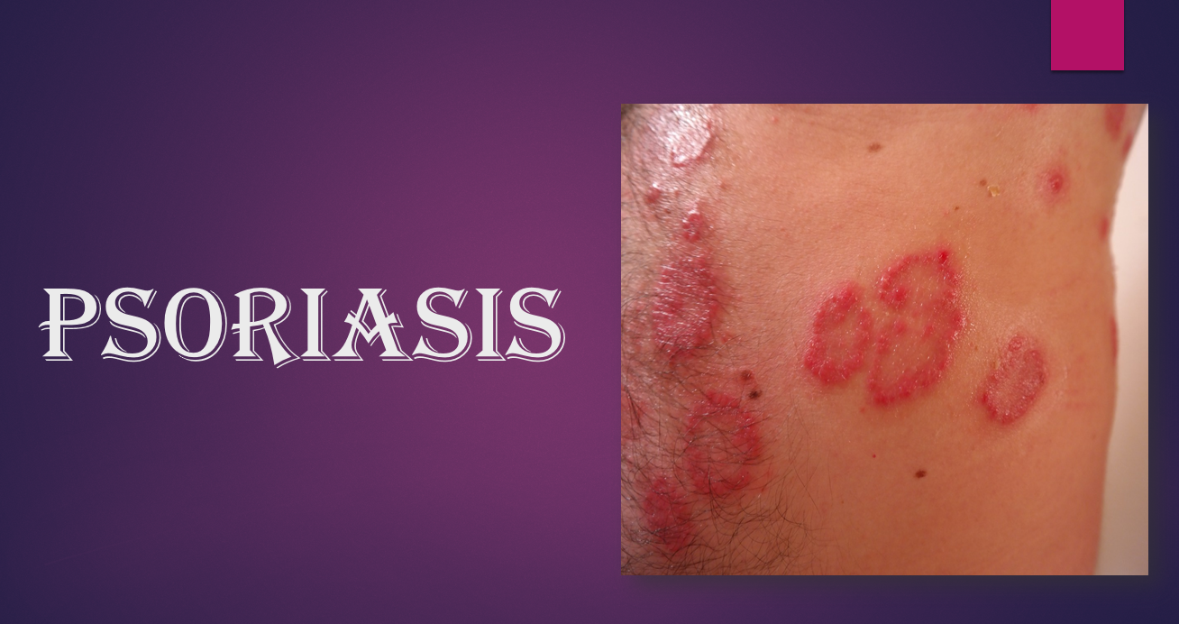 Psoriasis