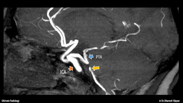 Ultimate Radiology : Persistent Trigeminal Artery (PTA), Tau sign
