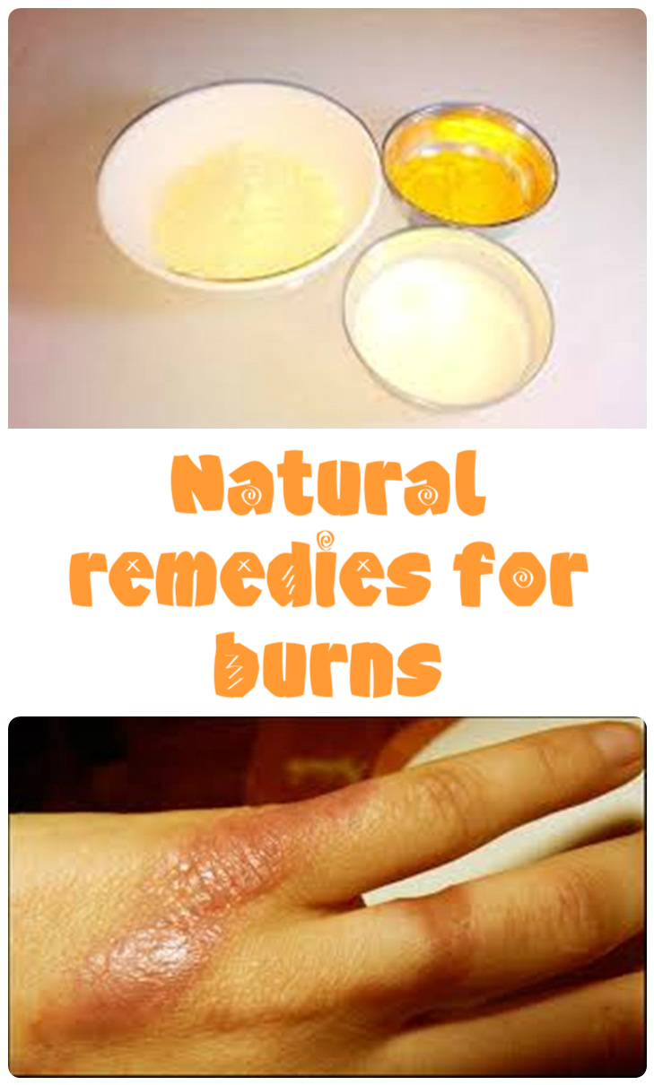 How to treat your burns - TOP 5 DIY