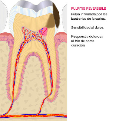 Entendiendo mi sonrisa : Pulpitis Reversible e Irreversible