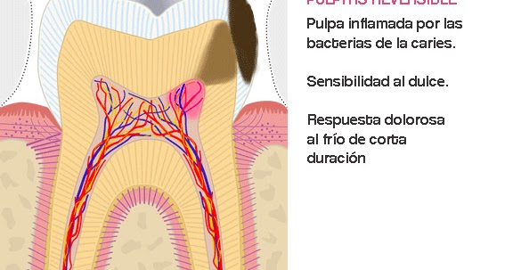 Entendiendo mi sonrisa : Pulpitis Reversible e Irreversible