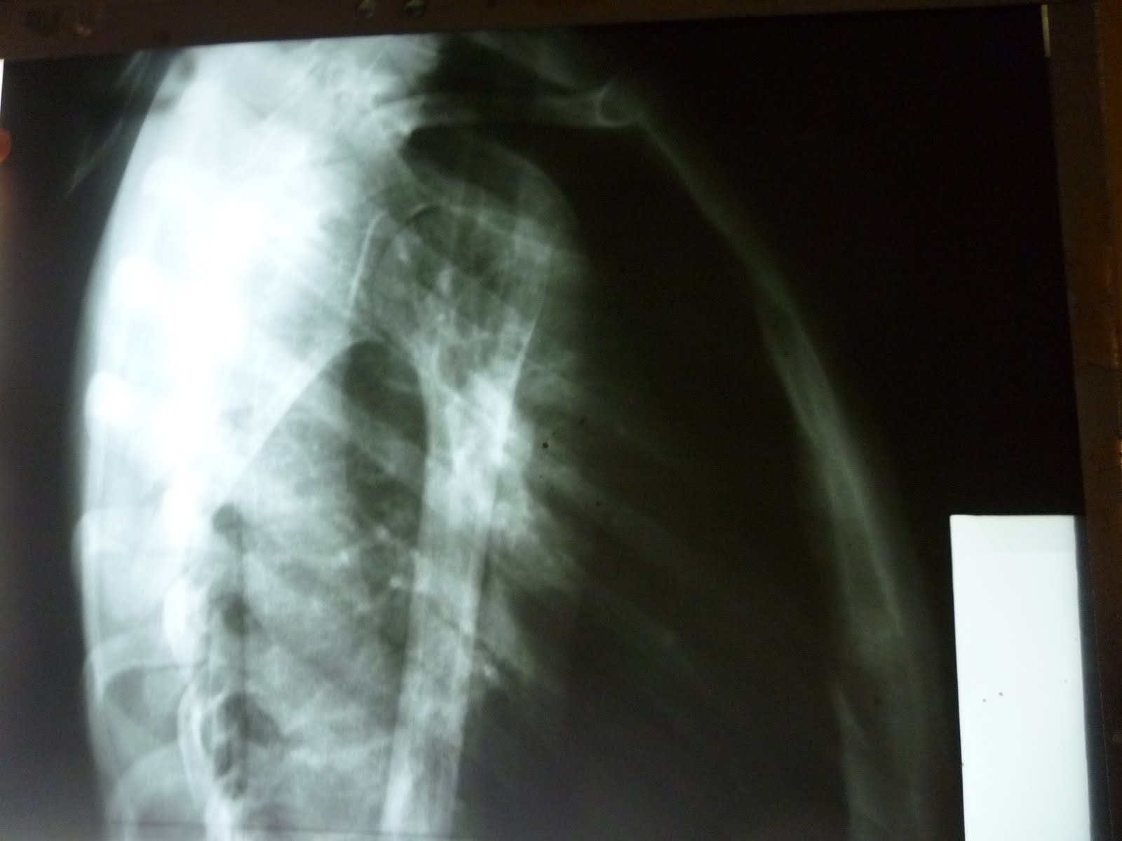 Rx011: Proyeccion Hombro