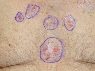 Pictures of skin cancer: Age spots or skin cancer