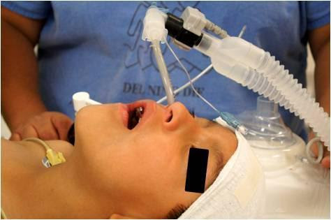 INTUBACIÓN ENDOTRAQUEAL