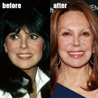 Marlo Thomas Plastic Surgery Before and After Facelift - Star Plastic ...