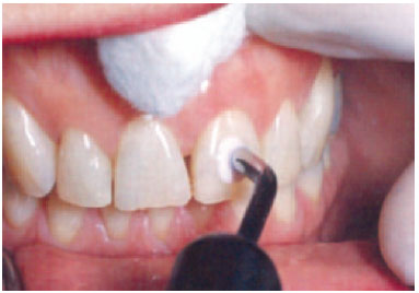 Diari Doktor Gigi: Gigi Mati (Pulp Necrosis)