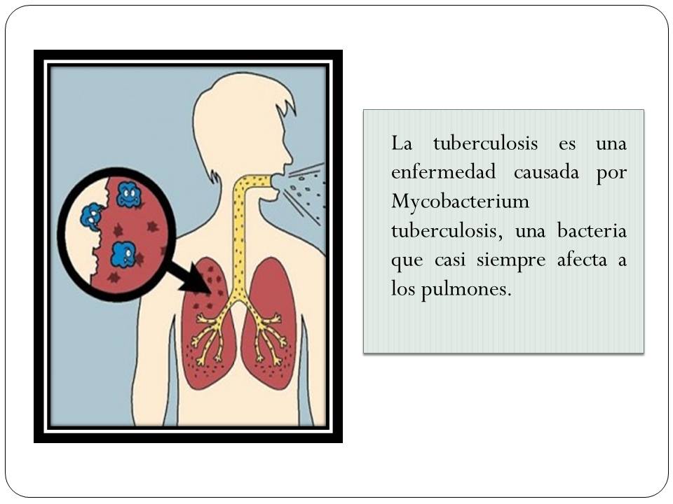 Tuberculosis TB