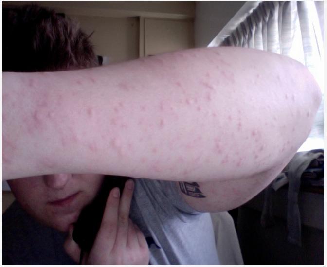 Bed Bug Bites Linear Pattern | Moreoo