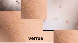 Avez-vous une verrue sur votre peau ? ~ Remède Naturel par les Plantes