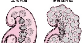 Traitement de Polykystique renale: Une nouvelle introduction du kyste ...